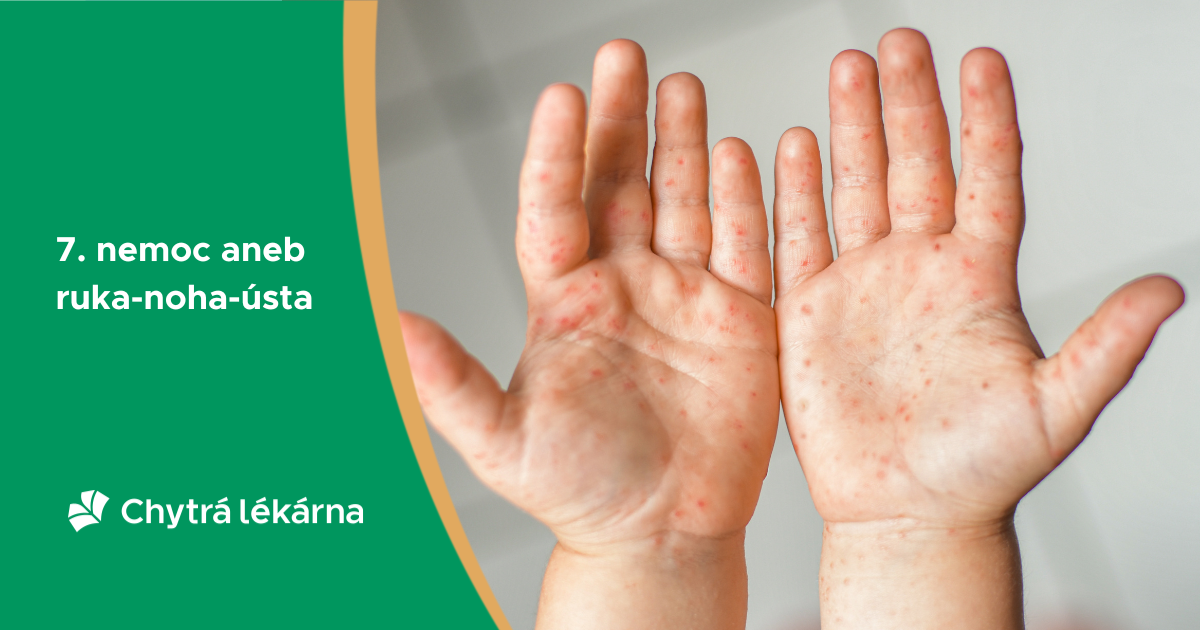 7. nemoc aneb ruka-noha-ústa | Lemon lékárna